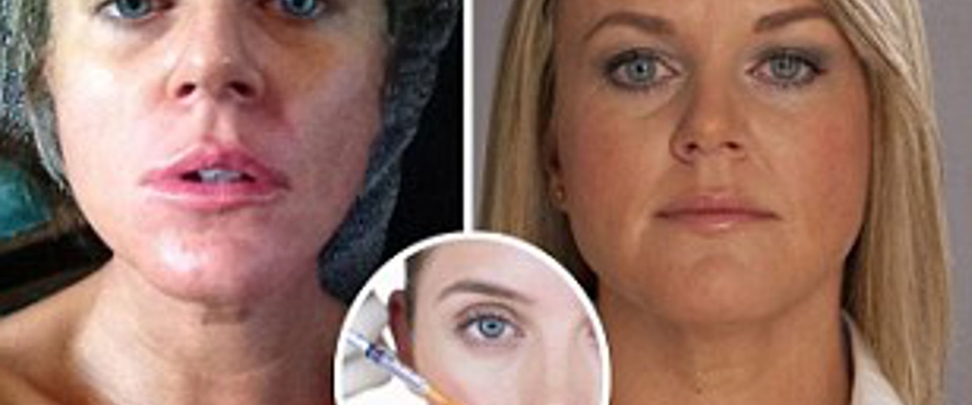 The Risks of Dermal Fillers: What You Need to Know